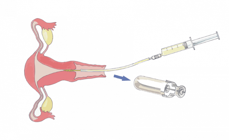 Phương pháp mới đánh giá vòi tử cung: Siêu âm bằng gel cản âm Hyfosy